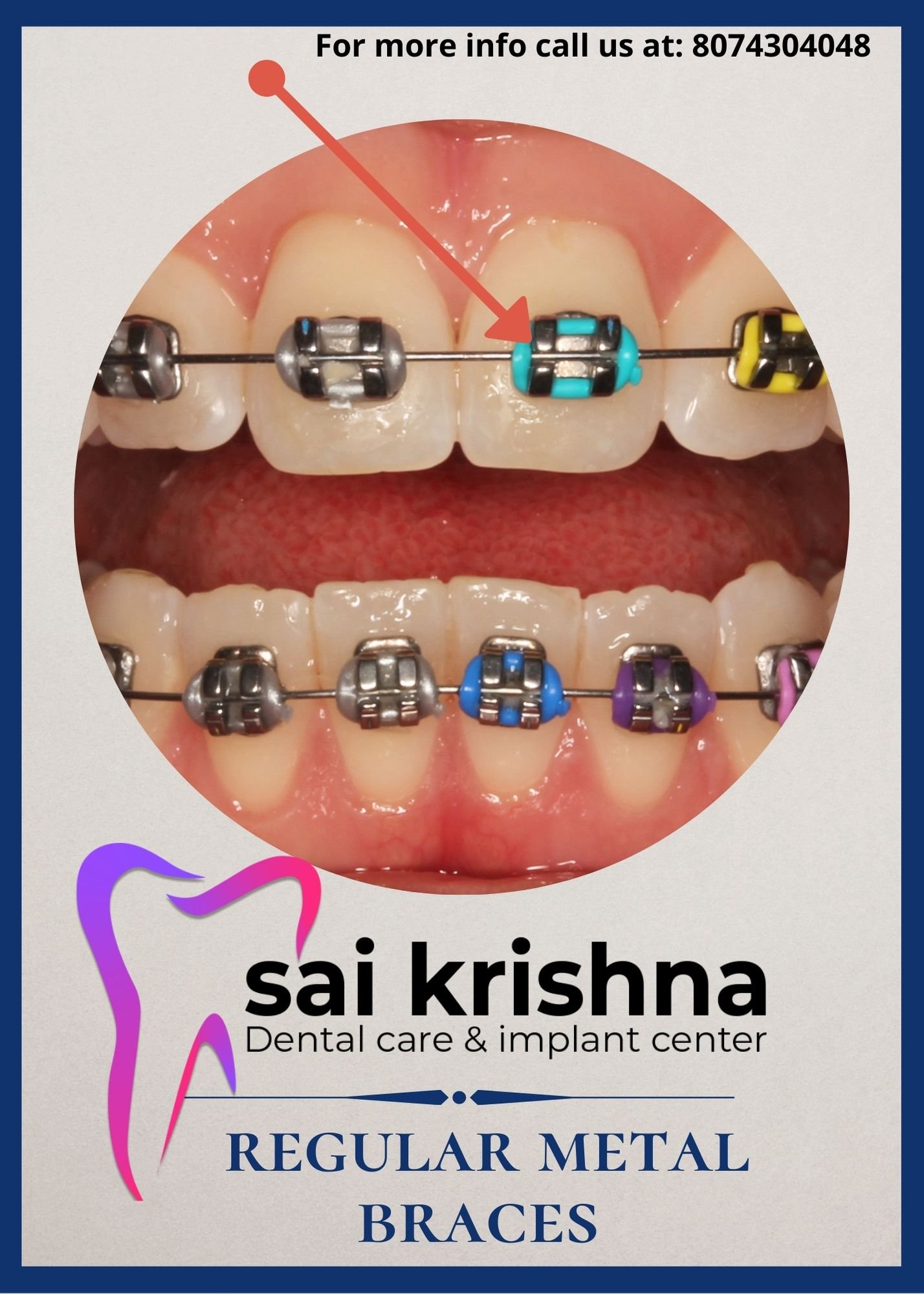 పళ్ళకి క్లిప్స్ ట్రీట్మెంట్ (Dental braces / Clips) చేయించుకునే ముంది ఇది ఒకసారి తెలుసుకోండి ...